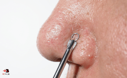 Blackheads Problem! Is it possible to permanently remove this skin ...
