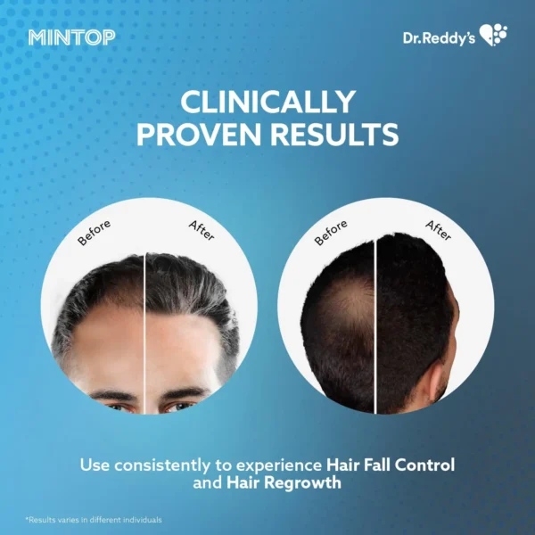 Dr. Reddy’s Mintop Forte 5% Minoxidil – 60ml | Hair Regrowth Solution ...